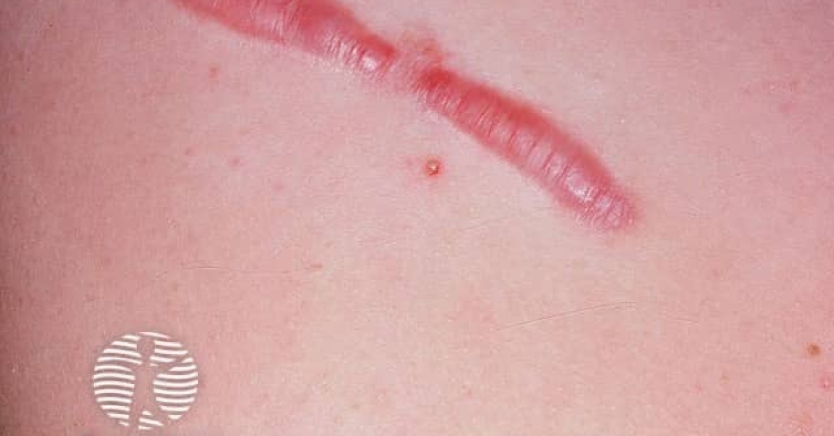 Keloid scar image