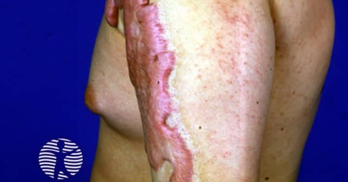 Keloid scar image