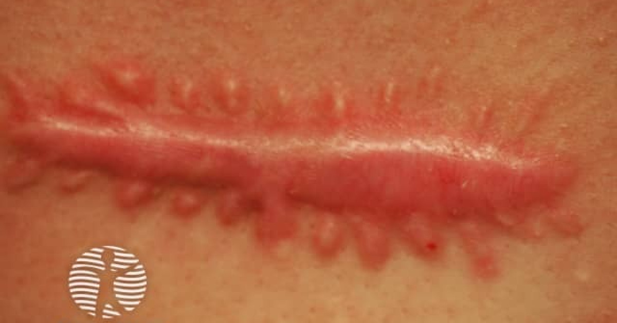 Keloid scar image