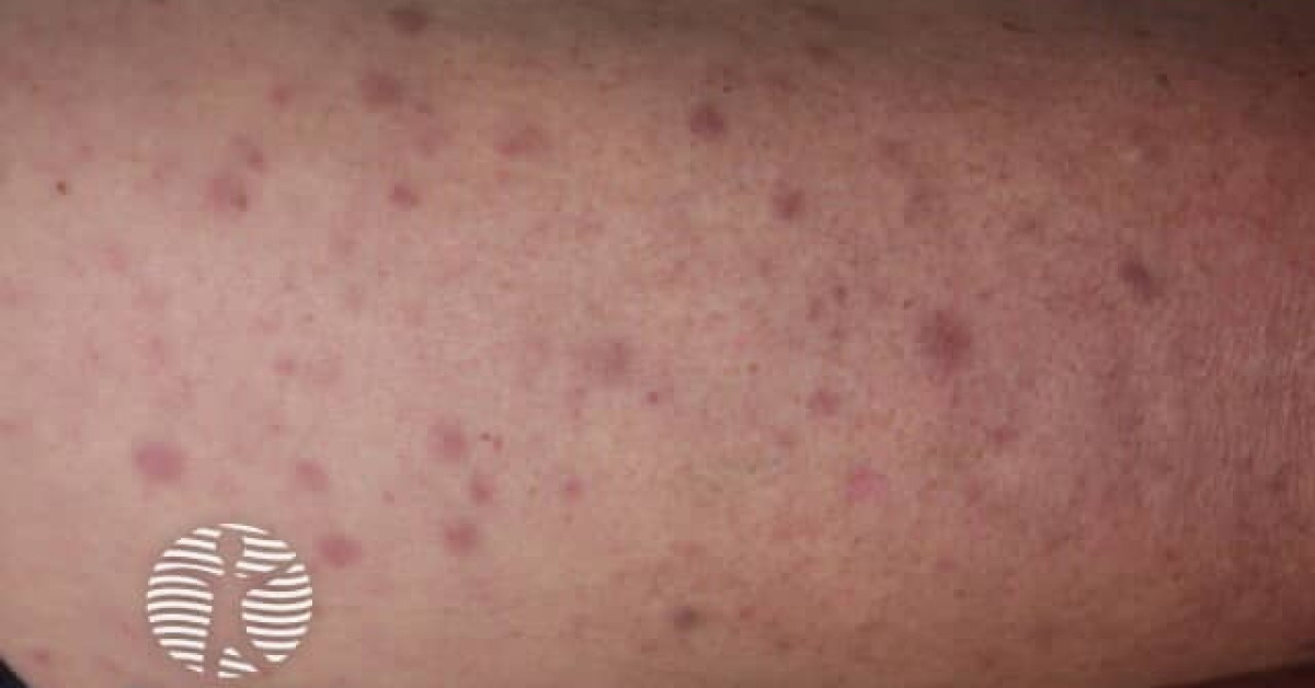 Leukaemia cutis image