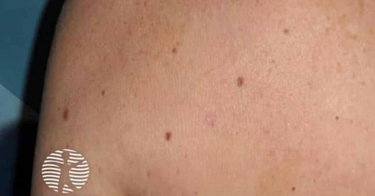 Mid-dermal elastolysis image