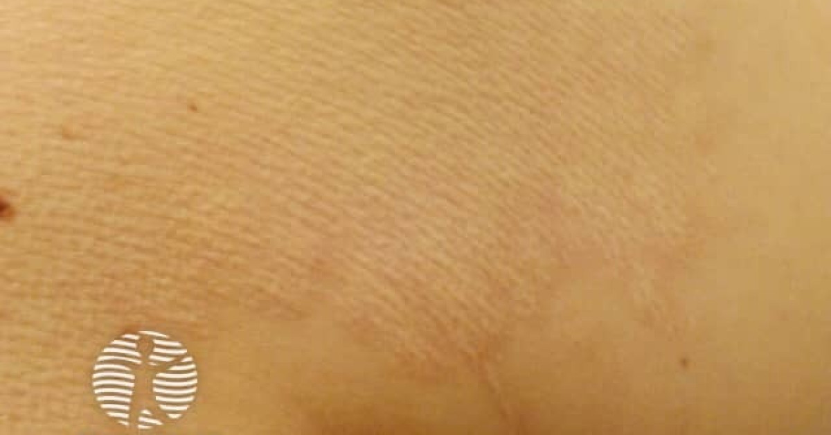 Mid-dermal elastolysis image