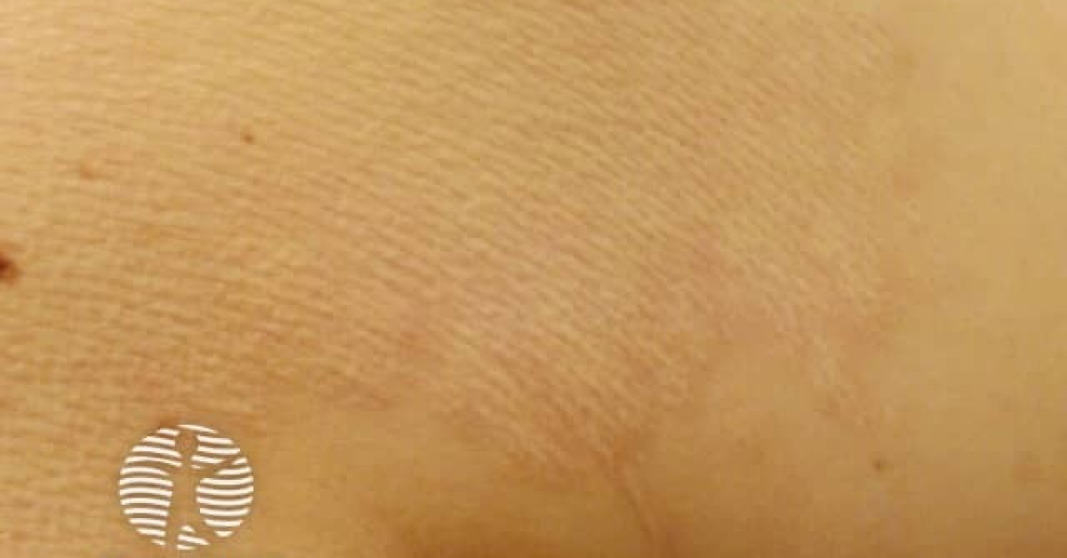 Mid-dermal elastolysis image