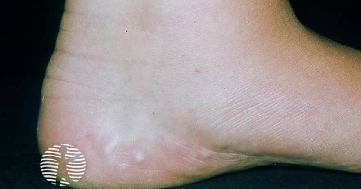 Piezogenic papules image