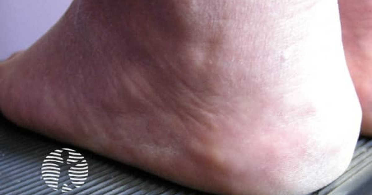 DermNet® - Piezogenic papules image