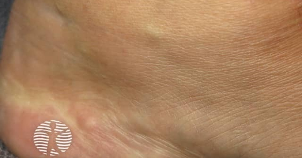 Piezogenic papules image