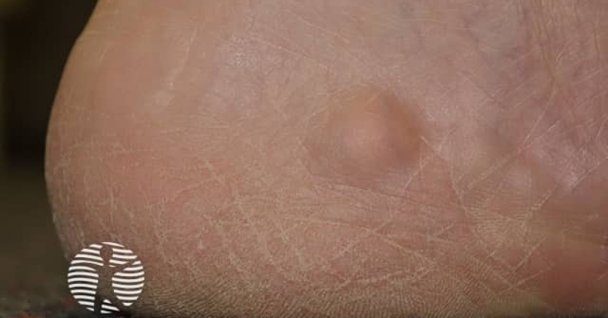 Piezogenic papules image