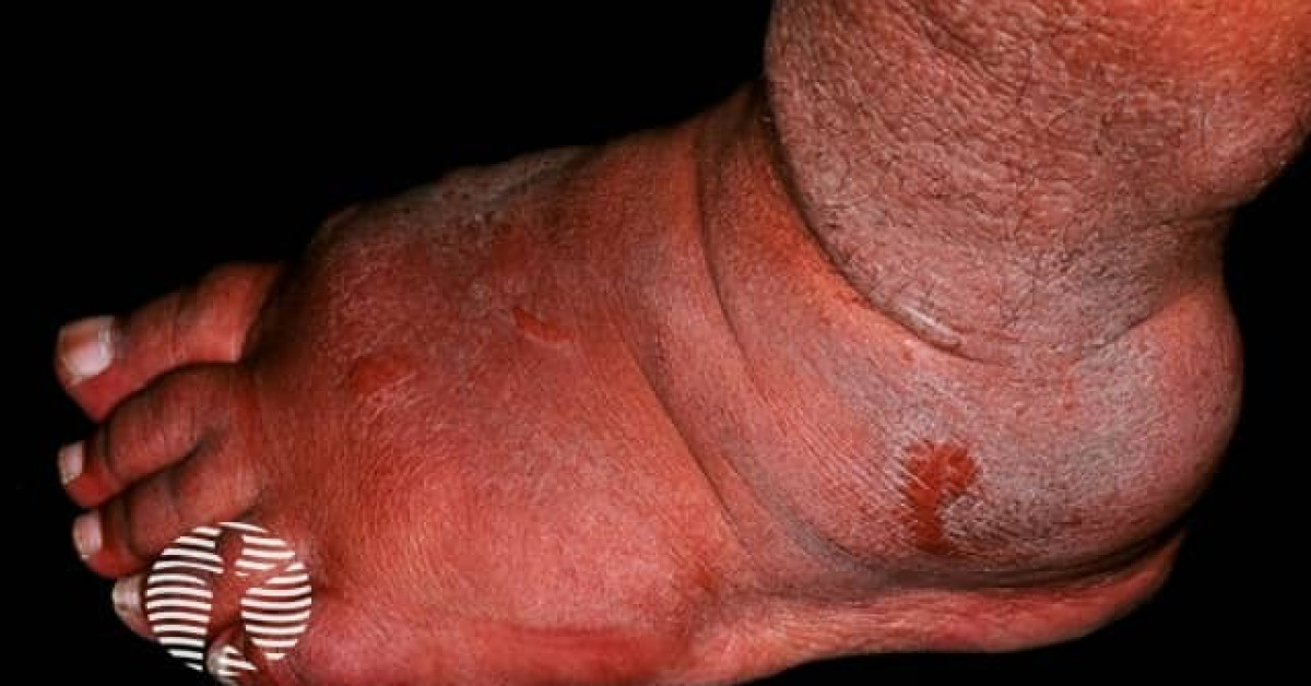 Pretibial myxoedema in Graves disease image