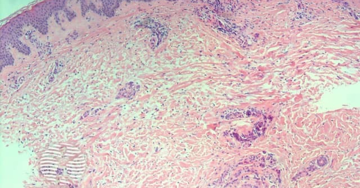 Pretibial myxoedema in Graves disease image