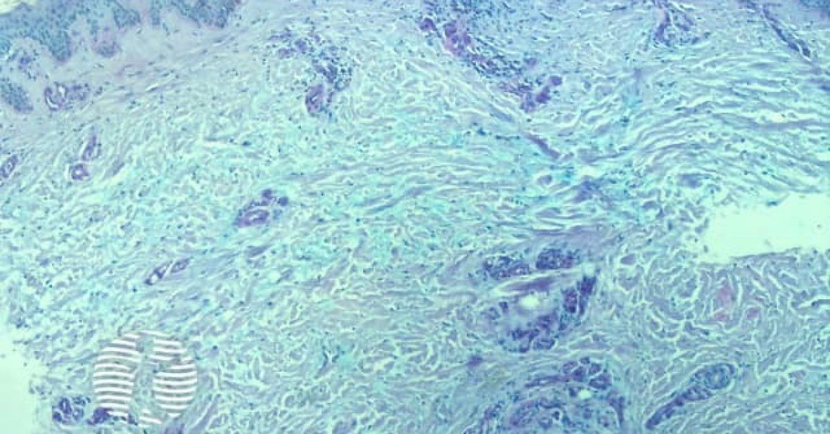 Pretibial myxoedema in Graves disease image