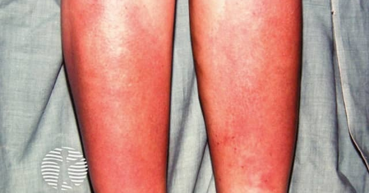 Pretibial myxoedema in Graves disease image
