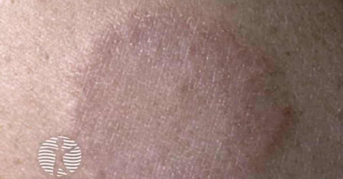 Granuloma annulare image