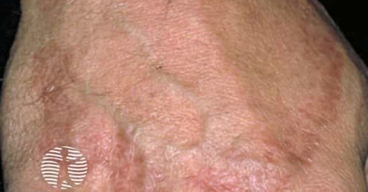 Granuloma annulare image