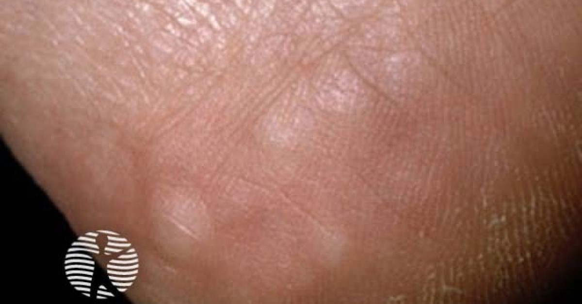 Piezogenic papules image