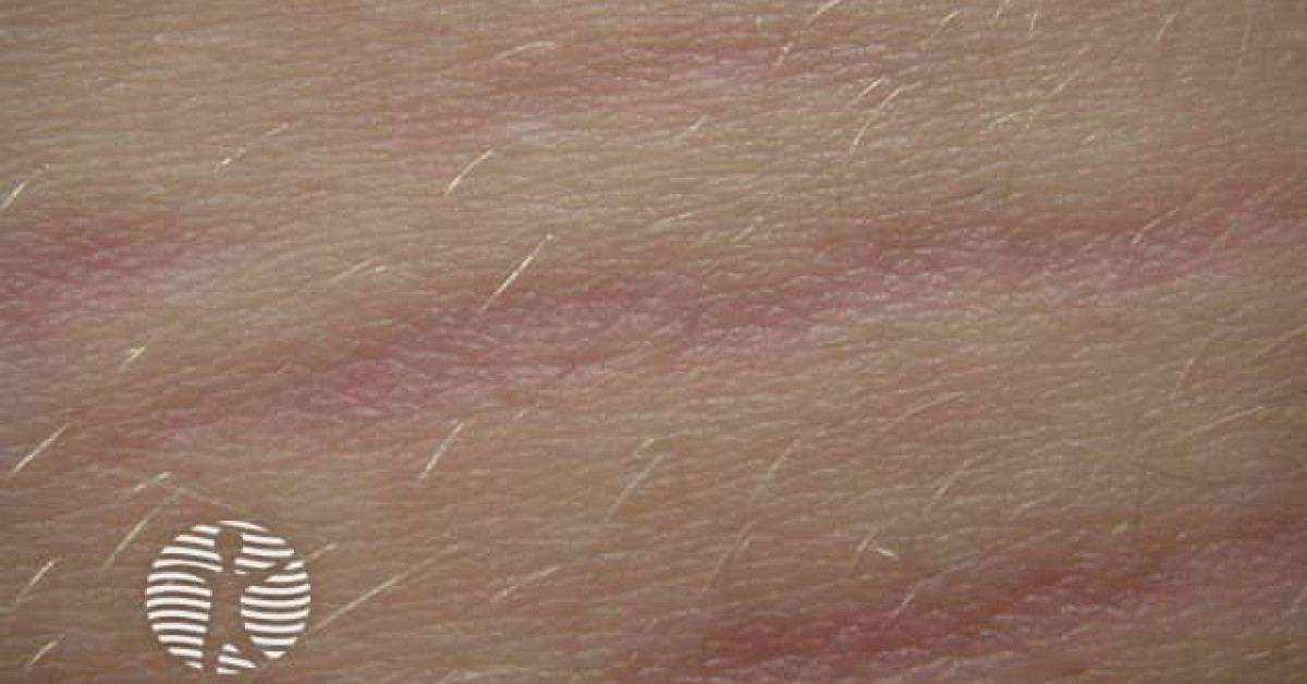 Stretch marks (striae) image
