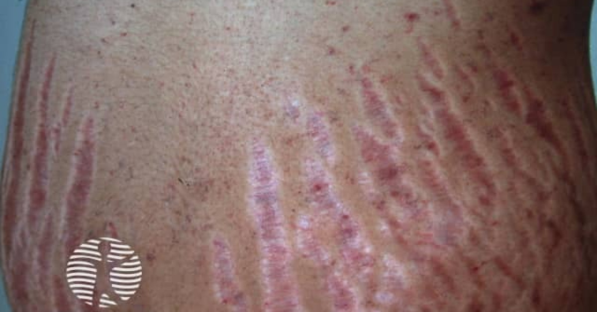 Stretch marks (striae) image