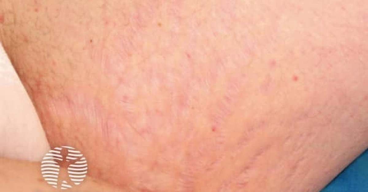 Stretch marks (striae) image