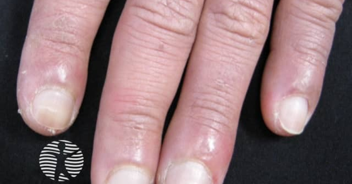 Thyroid acropachy image