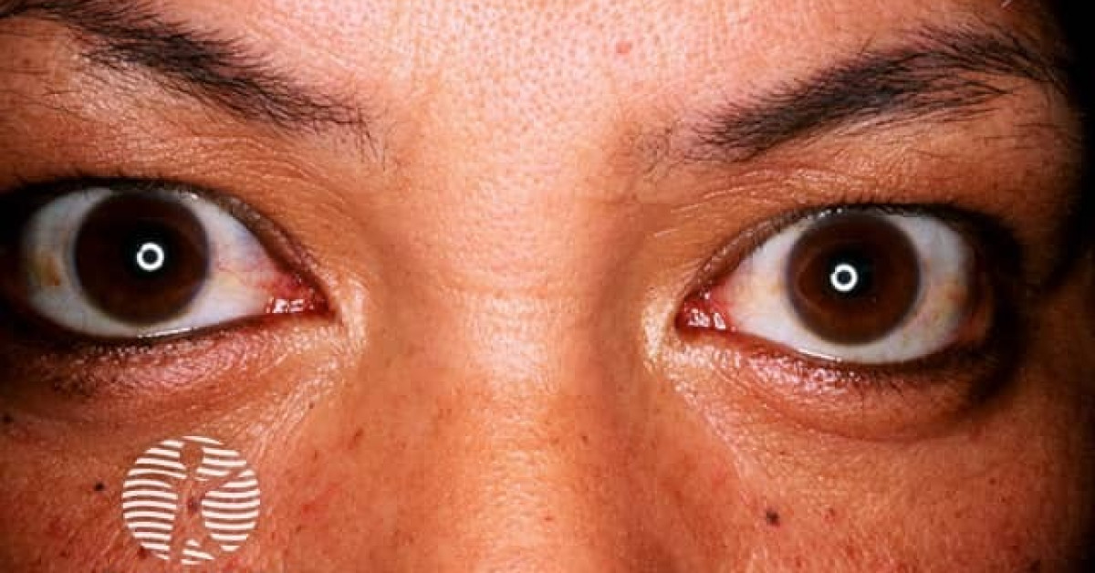 Thyroid ophthalmopathy image