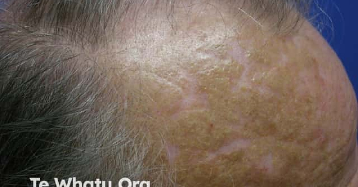 Solar elastosis image