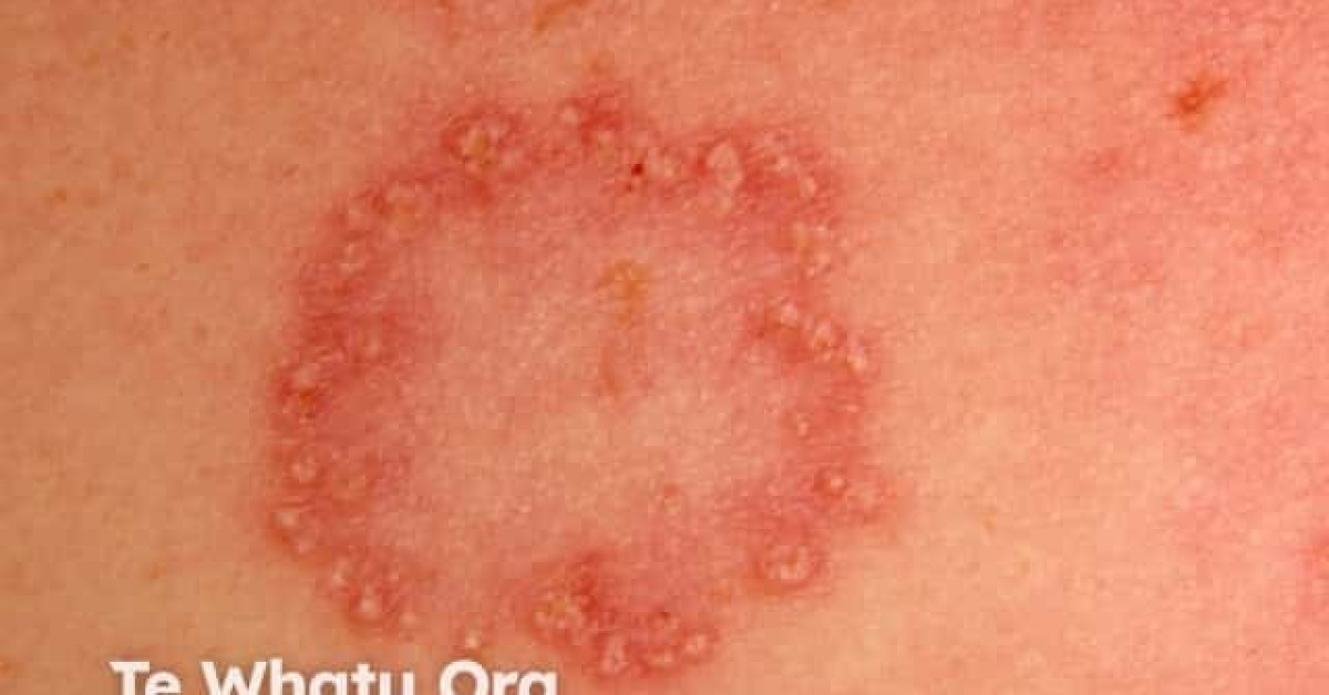 Elastosis perforans serpiginosa image