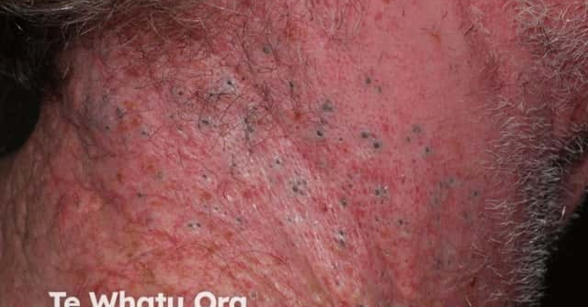 Favre Racouchot syndrome image