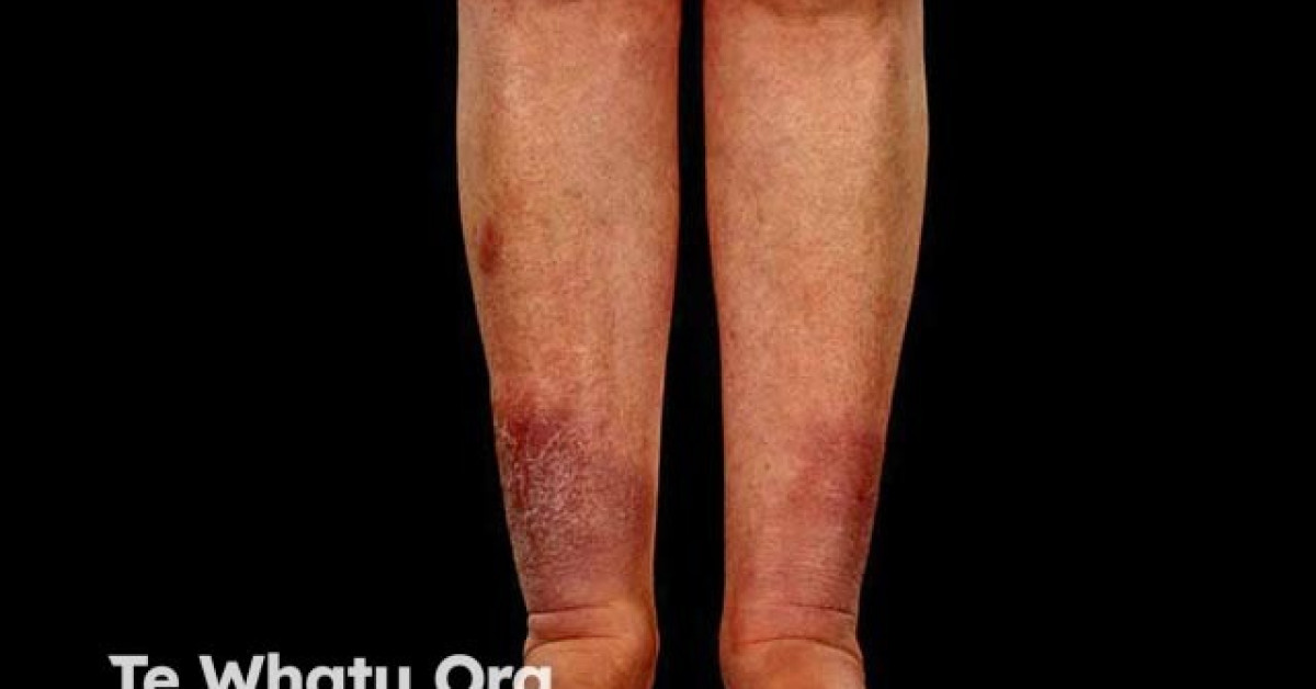 Pretibial myxoedema in Graves disease image