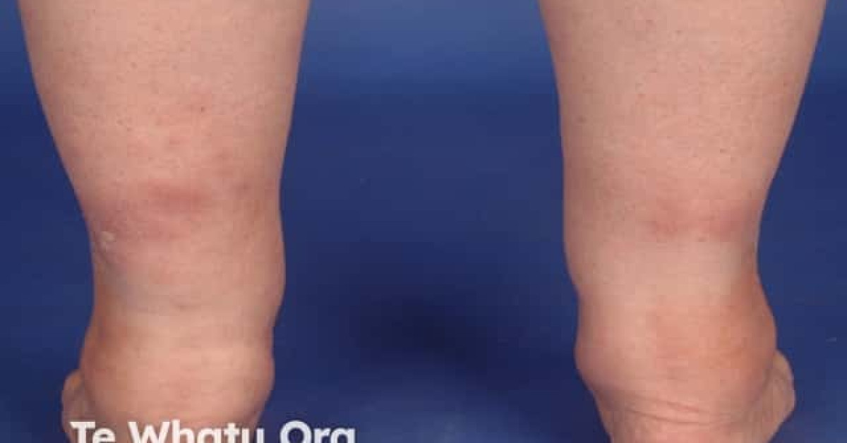 Pretibial myxoedema in Graves disease image