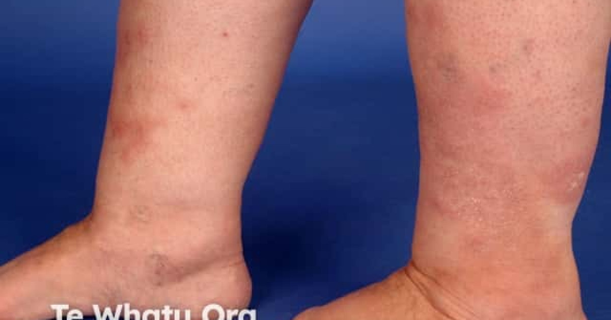 Pretibial myxoedema in Graves disease image