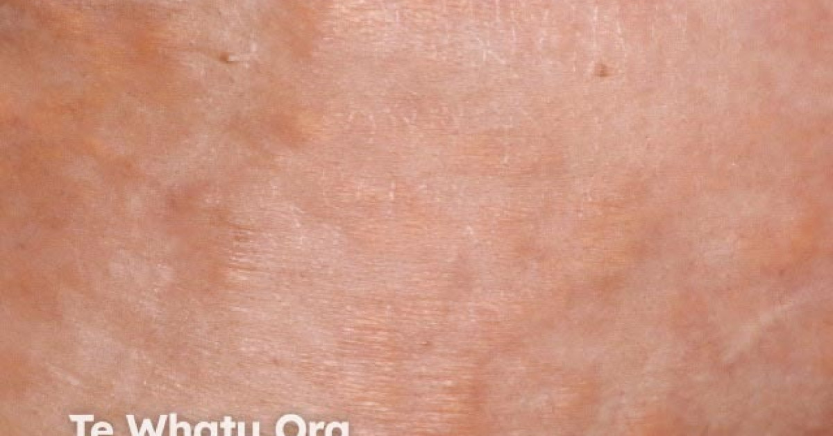 Diffuse plane xanthomas image