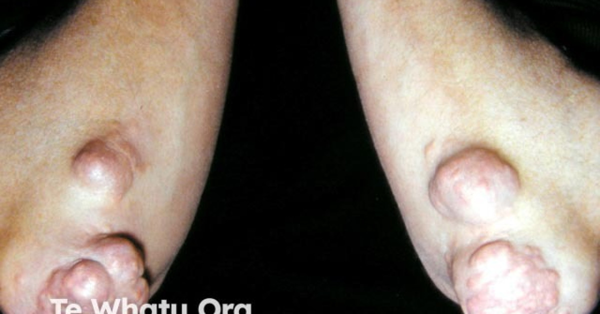 Tuberous xanthomas image