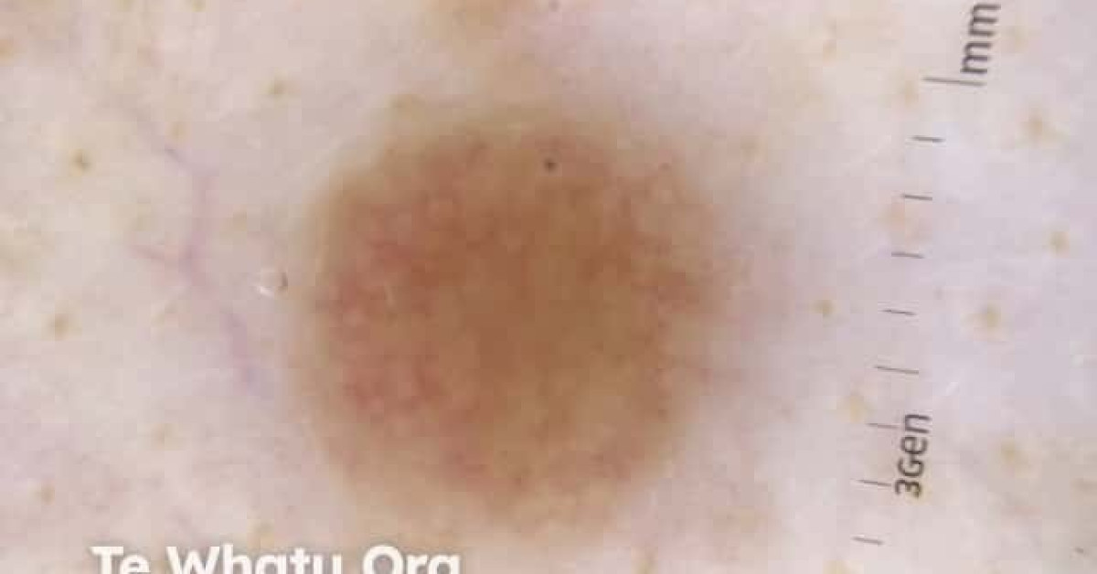 Melanocytic naevus image