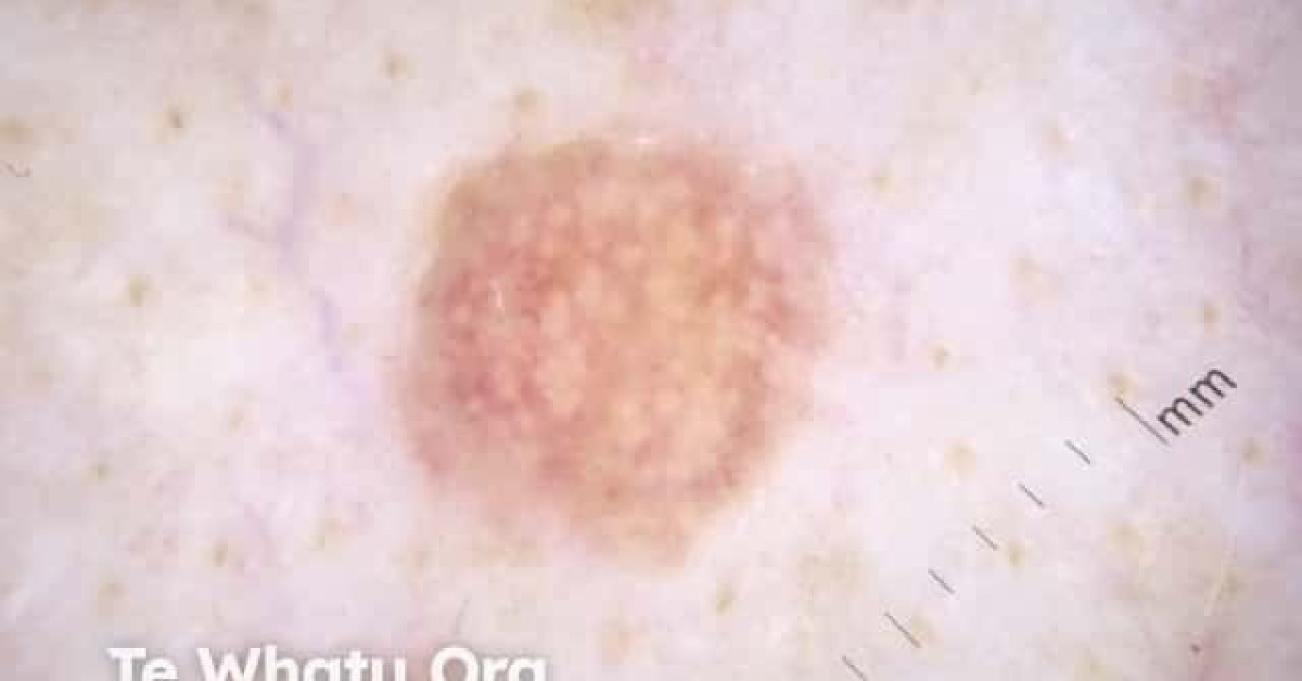 Melanocytic naevus image