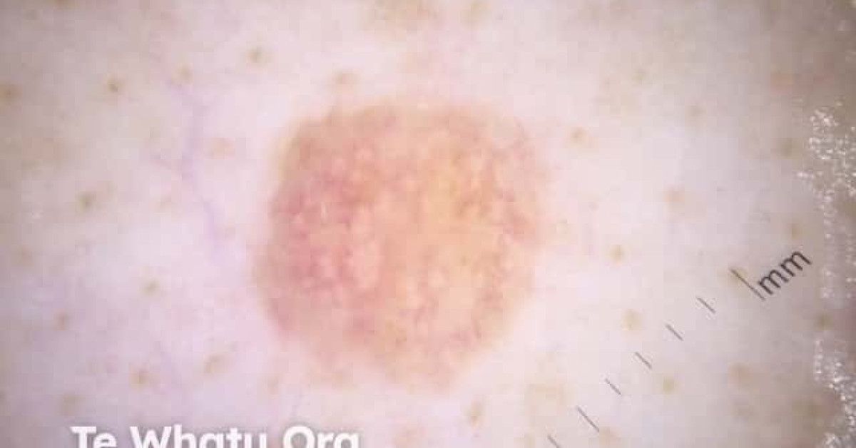 Melanocytic naevus image