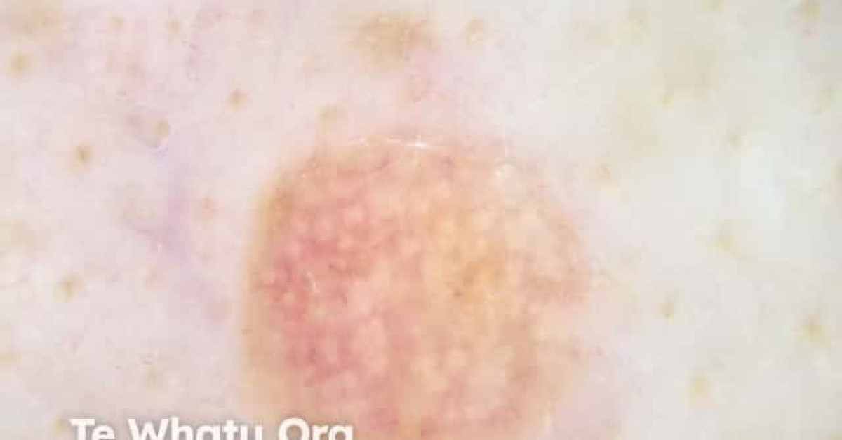 Melanocytic naevus image