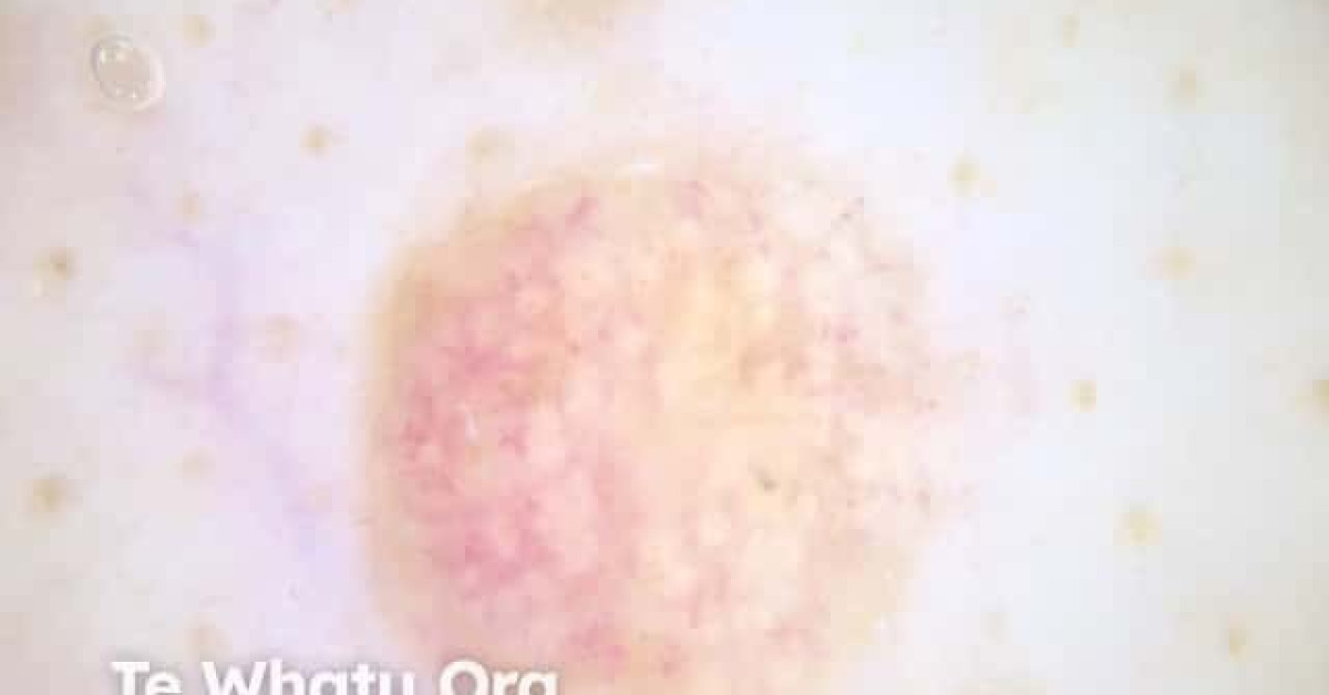 Melanocytic naevus image