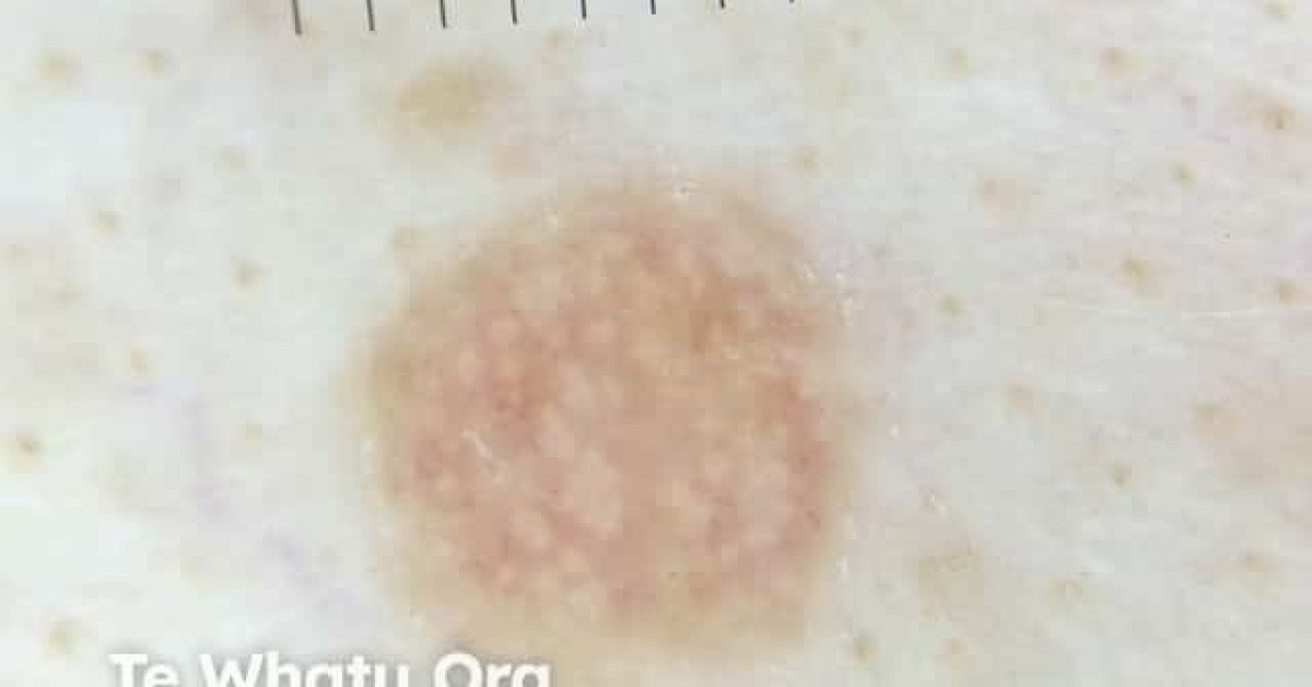 Melanocytic naevus image