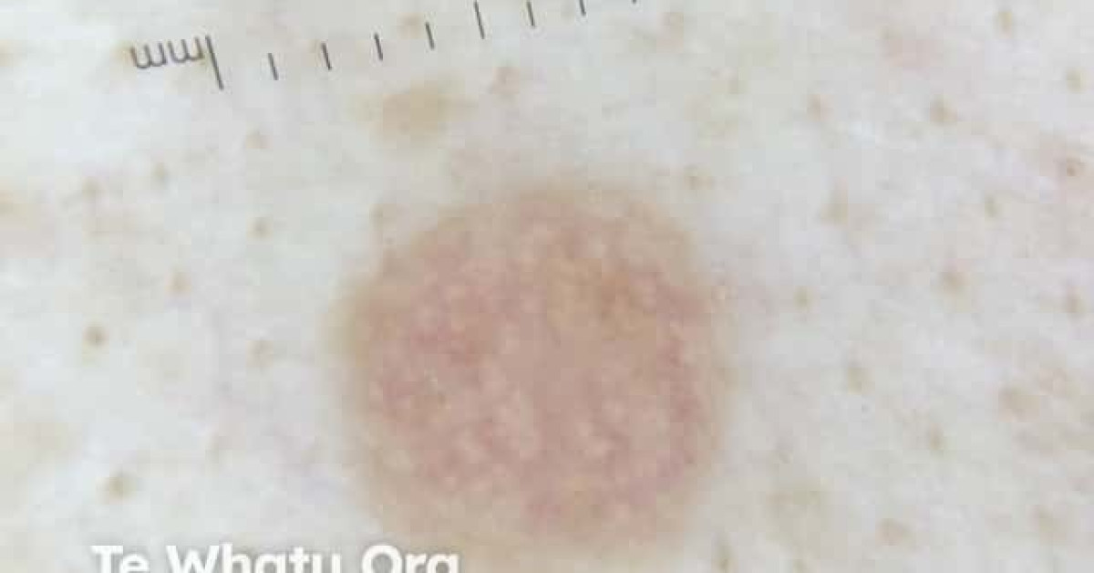 Melanocytic naevus image