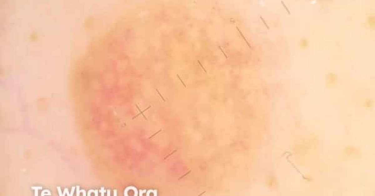 Melanocytic naevus image