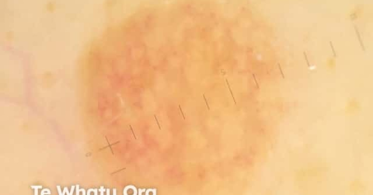 Melanocytic naevus image