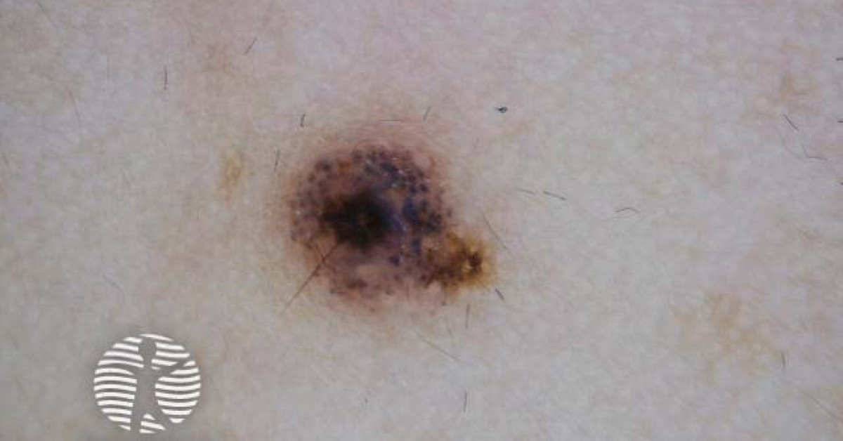 Dermal naevus, skin type 5, macro 2 image