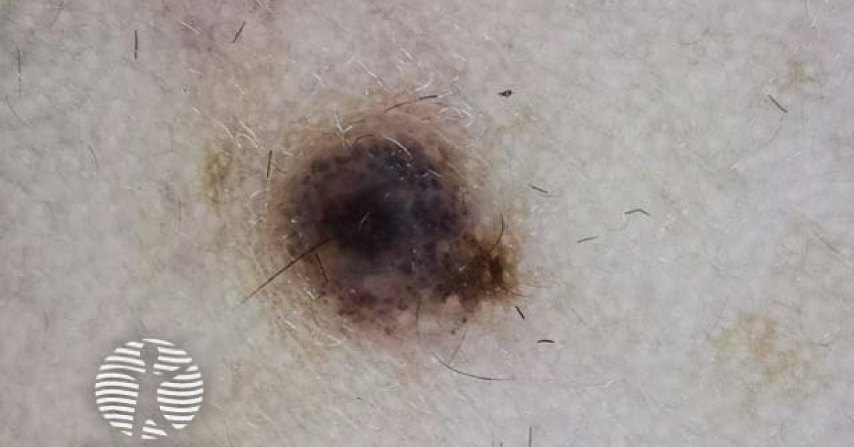 Dermal naevus, skin type 5, dermoscopy 2 image