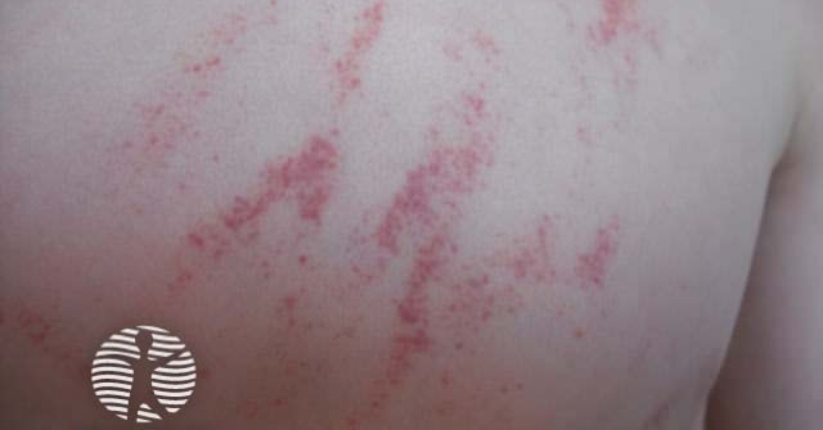 Dermatitis artefacta image