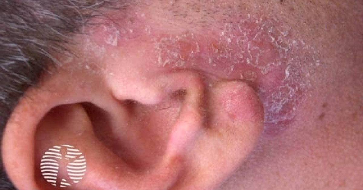 Airborne dermatitis due to epoxy allergy image