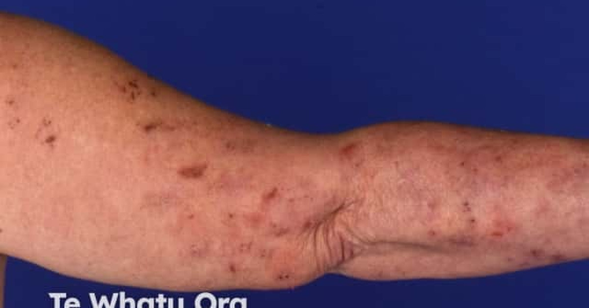 Dermatitis herpetiformis of elbow image