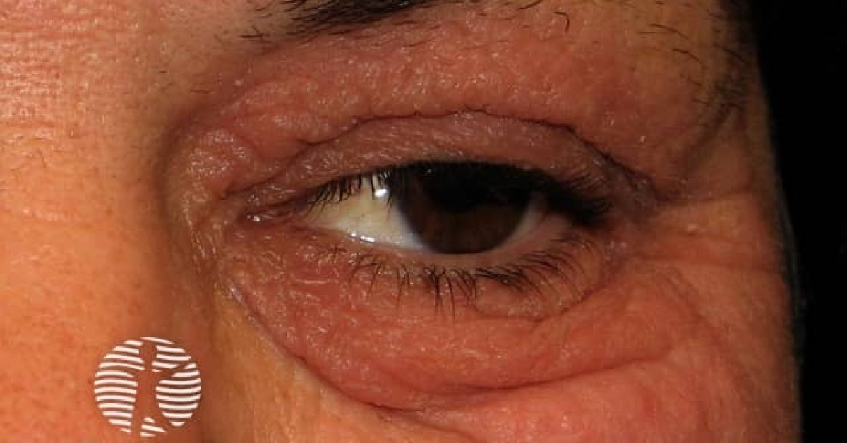 Contact allergic dermatitis around the eye image
