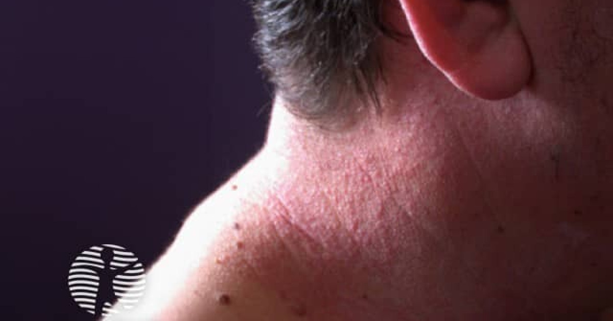 Contact allergic dermatitis image