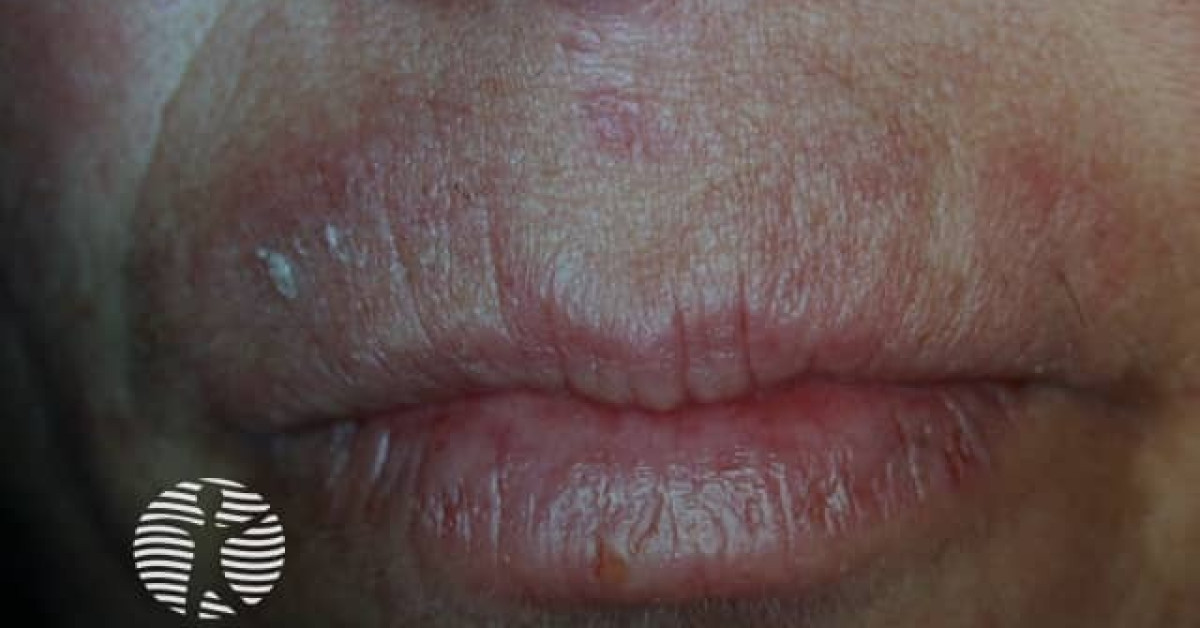 Contact allergic dermatitis around the lips image