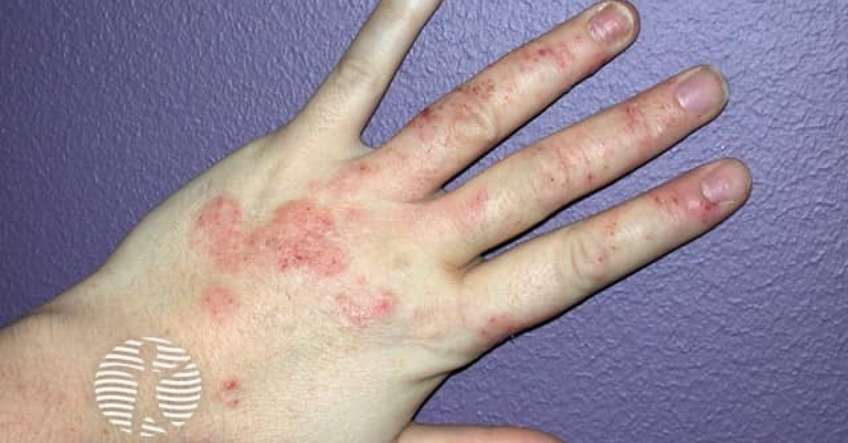 Contact allergic dermatitis of the hands image