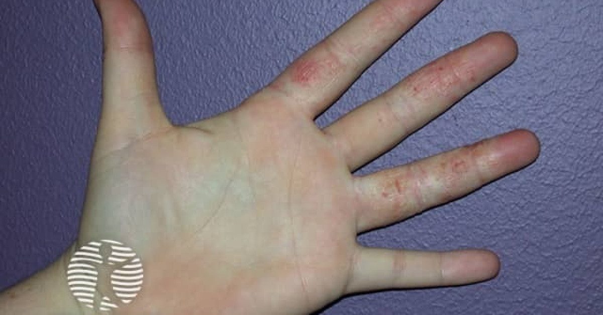 Contact allergic dermatitis of the hands image